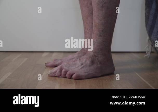 Sick elderly leg. Senior leg problems. Legs old woman with crippled ...