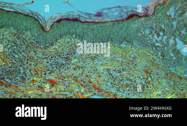 Herpes zoster of the skin Shingles tissue at high magnification under ...