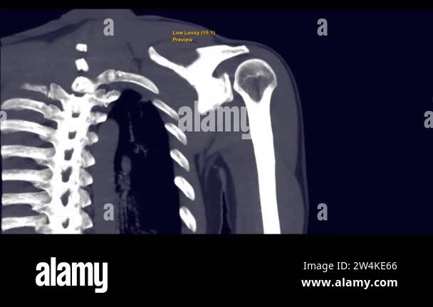 CT scan 3D of Left shoulder coronal view showing fracture head of ...
