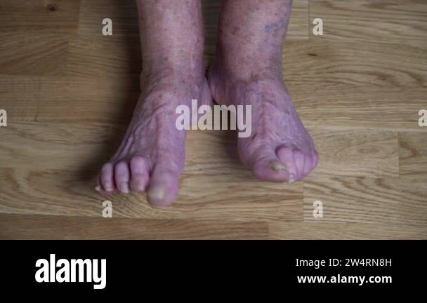 Sick elderly leg. Senior leg problems. Legs old woman with crippled ...