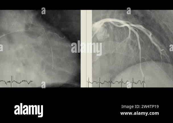 Coronary angiography is a test used to find out how much narrowing ...
