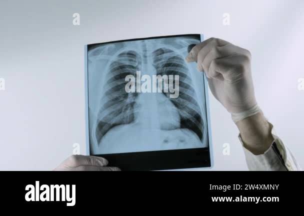 X-ray image of human lungs in the hands of a doctor on a white ...