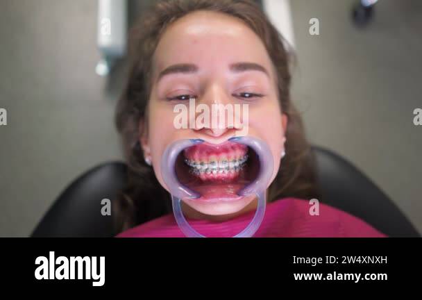 Young Woman Patient with Retractor in Mouth with Braces in Dental ...