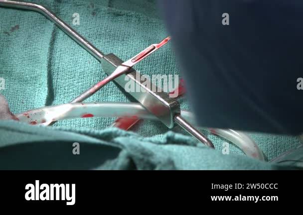 Surgical instruments blood Stock Videos & Footage - HD and 4K Video ...