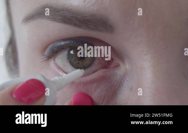 Female Using Medical Solution to Moisturise and Heal her Eye with ...