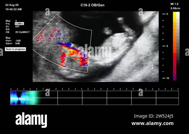 Ultrasound doppler waveform Stock Videos & Footage - HD and 4K Video ...