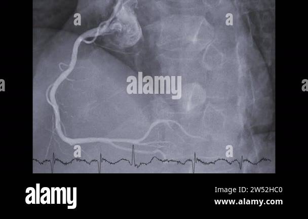 Coronary angiography is a test used to find out how much narrowing ...