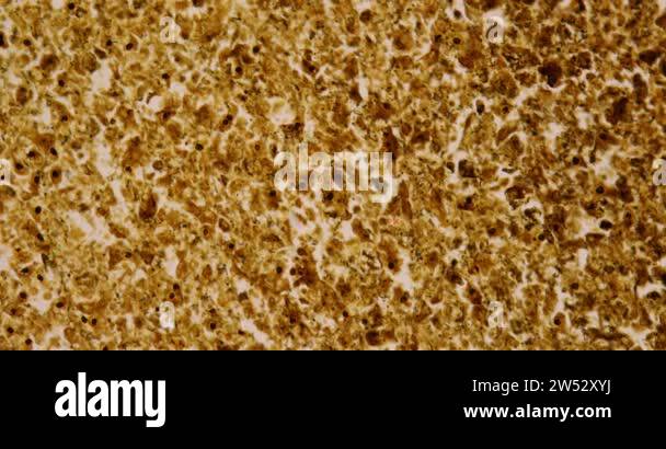 Syphilis infection of the liver under the microscope 100x Stock Video ...