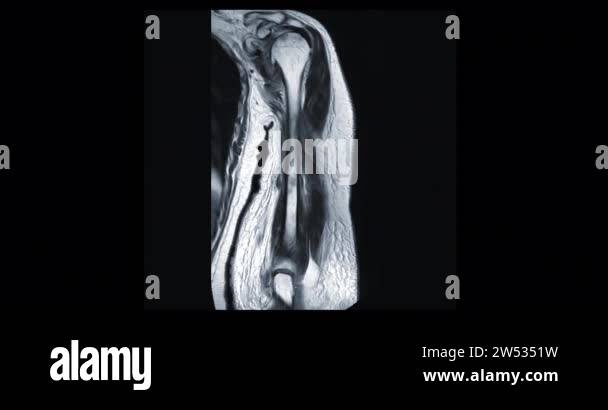MRI Arm or humerus bone , Magnetic resonance imaging of Arm or humerus ...