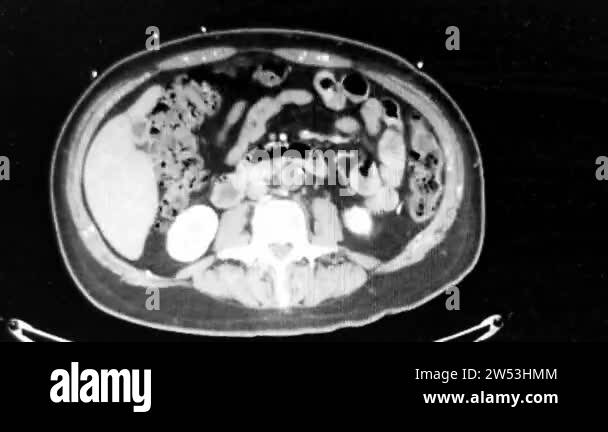 Xrays human heart Stock Videos & Footage - HD and 4K Video Clips - Alamy