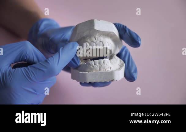 Plaster cast of the upper and lower jaw in the hands of an orthodontist ...