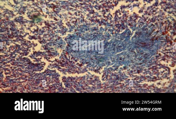 Tumor of the gallbladder under the microscope 100x Stock Video Footage ...