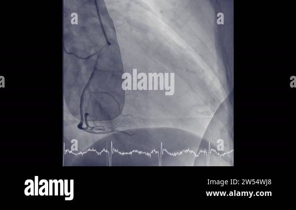 Coronary angiography is a test used to find out how much narrowing ...