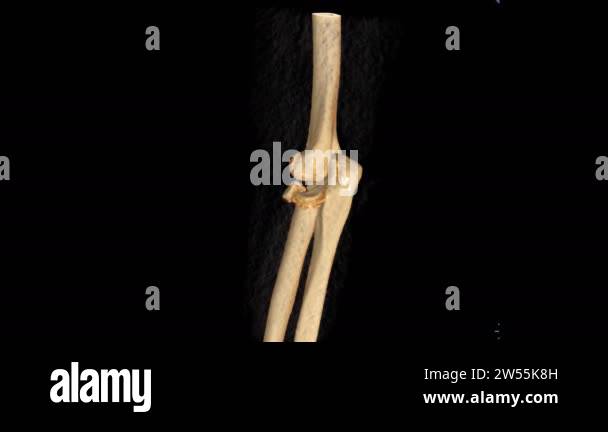 Ct Scan Elbow Joint Stock Videos And Footage Hd And 4k Video Clips Alamy