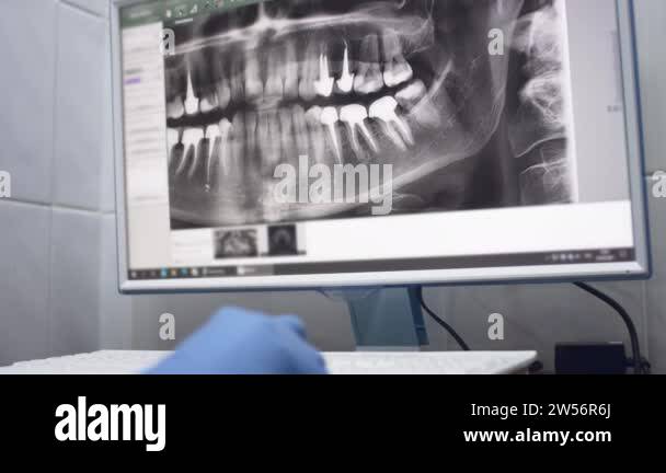 Dentist doctor examines a panoramic x-ray of the jaw on a computer ...