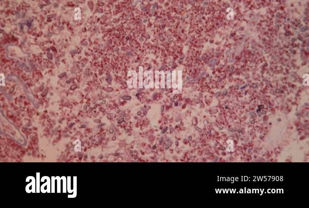 Rabbit cocticitis of the liver tissue under the microscope 100x Stock ...