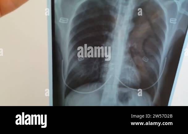 Physician checks lungs female Stock Videos & Footage - HD and 4K Video ...