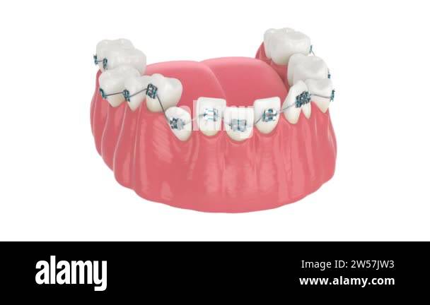 Orthodontic teeth alignment Stock Videos & Footage - HD and 4K Video ...