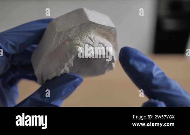 The plaster 3 d model of the maxilla in the hands of an orthodontist in ...