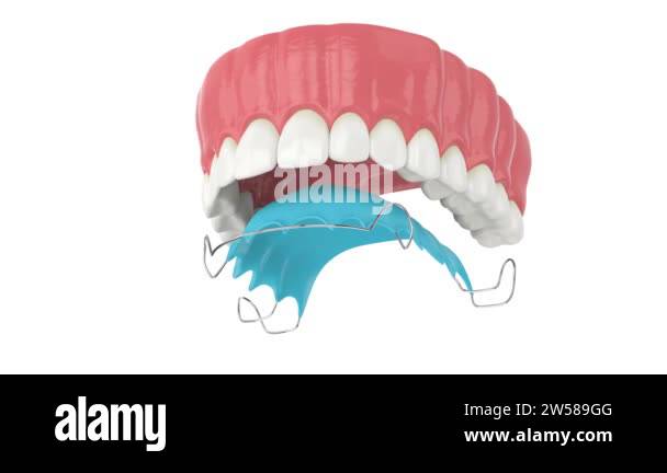 Retainer retainer orthodontic Stock Videos & Footage - HD and 4K Video ...