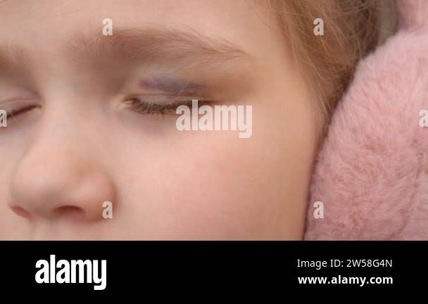 close up. A bruise on the little girls left eye. bruised eyelid Stock ...