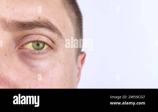 The yellow color of the man eye. Symptom of jaundice, hepatitis or ...