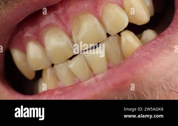 Enamel defect Stock Videos & Footage - HD and 4K Video Clips - Alamy
