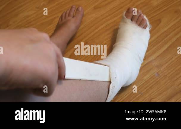 Women leg in a plaster cast toes moving. Itchy legs. Scratches his ...