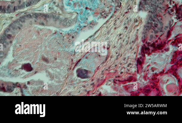 carcinoma large intestine tissue under the microscope 200x Stock Video ...