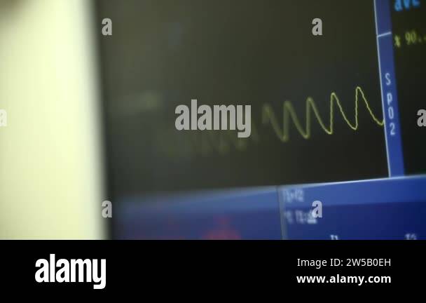 Close up of Heart rate monitor in hospital theater. Medical vital signs ...
