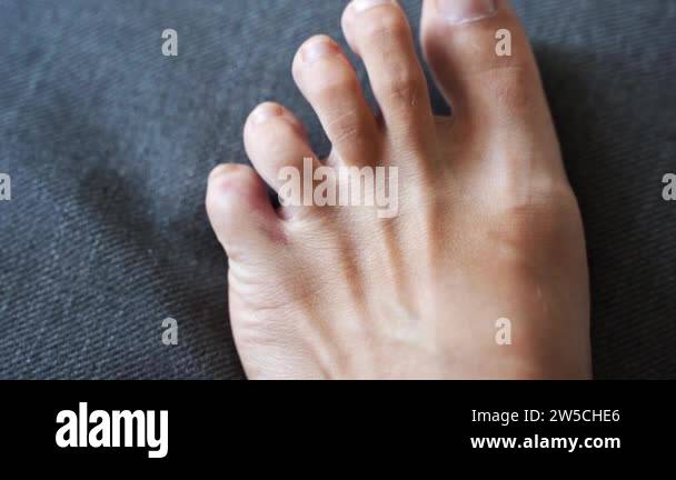 Foot little finger injury. Little toe pain and bruise after home ...