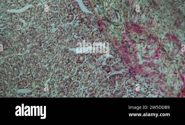 Diverticulosis large intestine tissue under the microscope 100x Stock ...