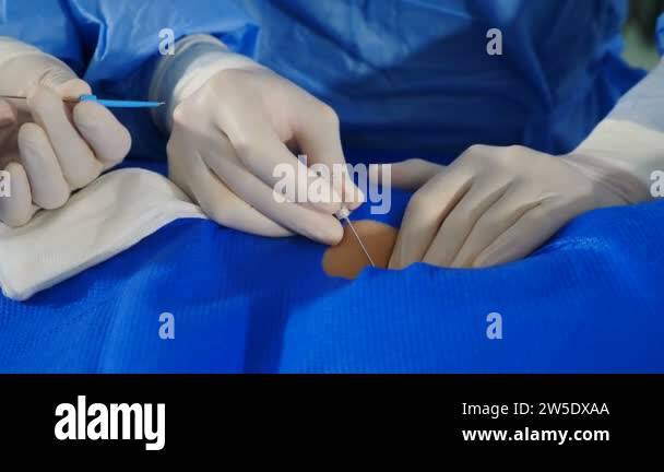 Vascular surgery. Radiologist performs endovascular operation with ...
