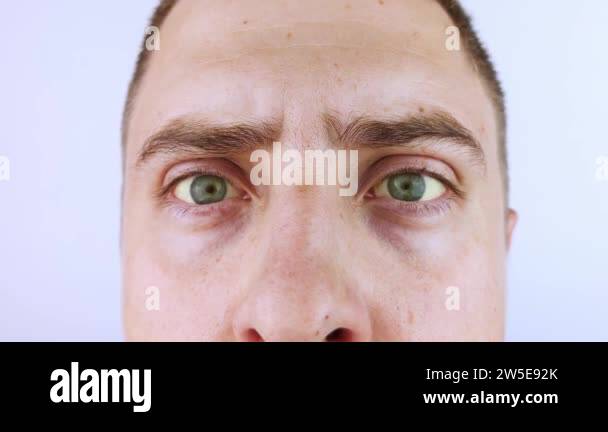 The yellow color of the man eye. Symptom of jaundice, hepatitis or ...