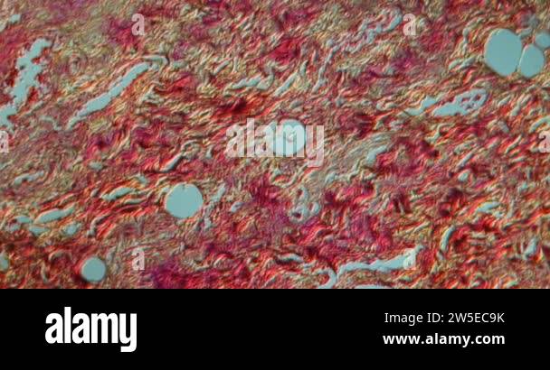 Diverticulosis large intestine tissue under the microscope 100x Stock ...