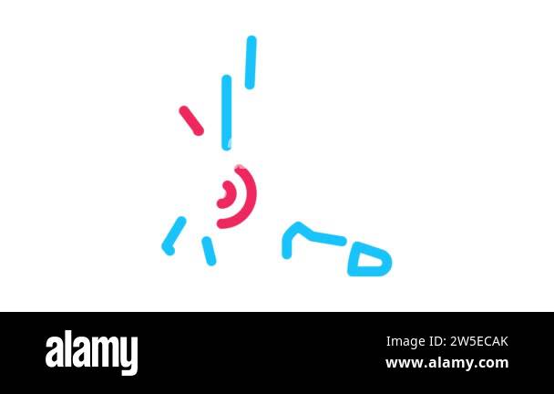 Rheumatoid arthritis x ray fingers Stock Videos & Footage - HD and 4K ...