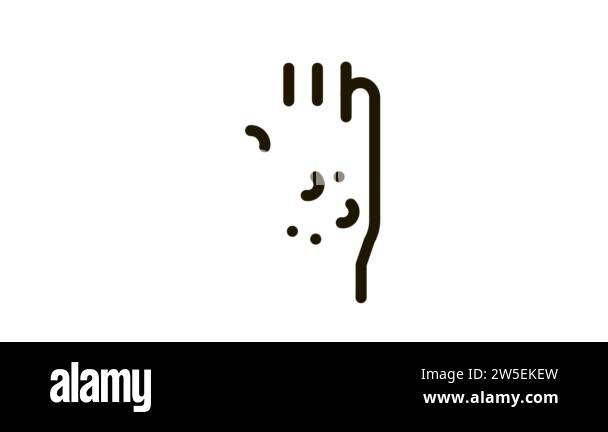 dermatitis rash on hands Icon Animation Stock Video Footage - Alamy