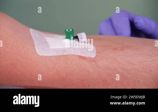 Intravenous cannulation procedure. Nurse or doctor inserting cannula ...