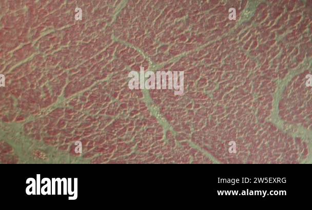 Heart attack tissue under microscope Stock Videos & Footage - HD and 4K ...