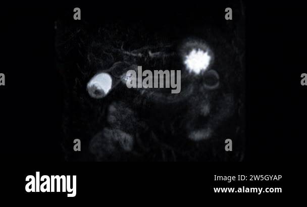 MRCP or Magnetic resonance cholangiopancreatography Coronal MIP showing ...