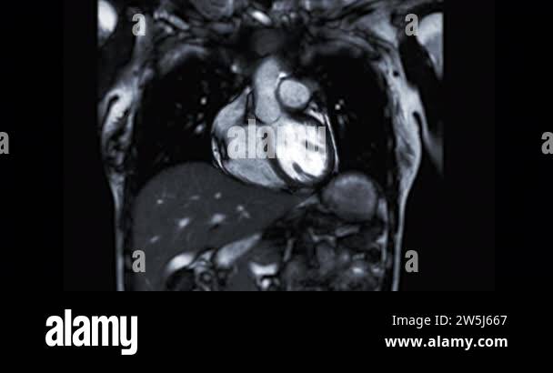 MRI heart or Cardiac MRI ( magnetic resonance imaging of heart ...