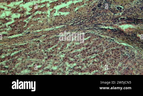 Liver diseased tissue under the microscope 100x Stock Videos & Footage ...