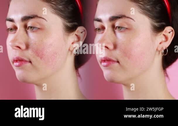 A face of a young caucasian woman in close-up showing the result before ...