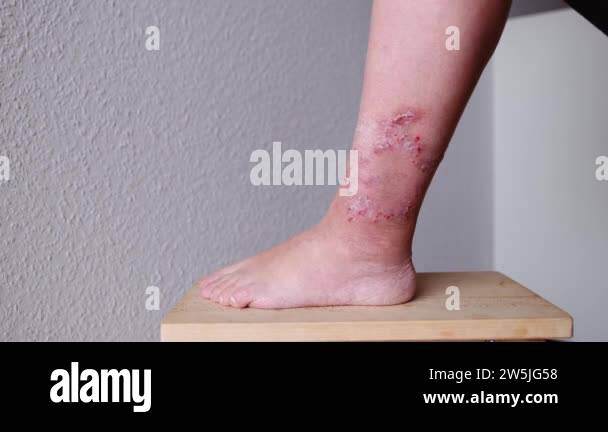 doctor treats a large healing wound from on lower leg with scars of ...