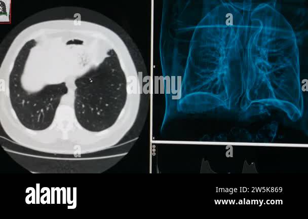 CT of lungs with confirmed case of coronavirus Covid-19 respiratory ...