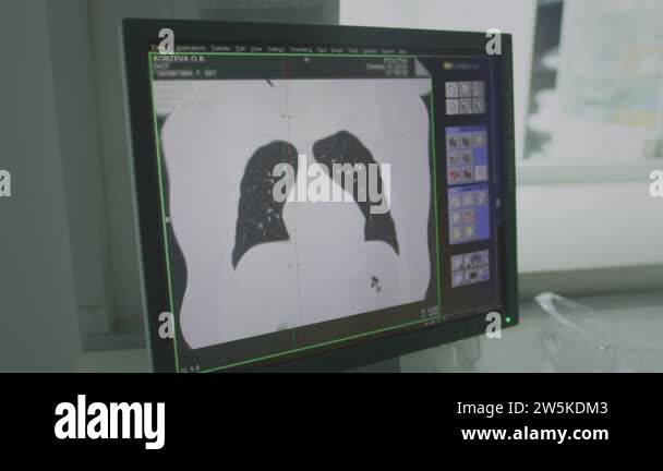 The result of a scan of the lungs on a computed tomograph. Lung model ...