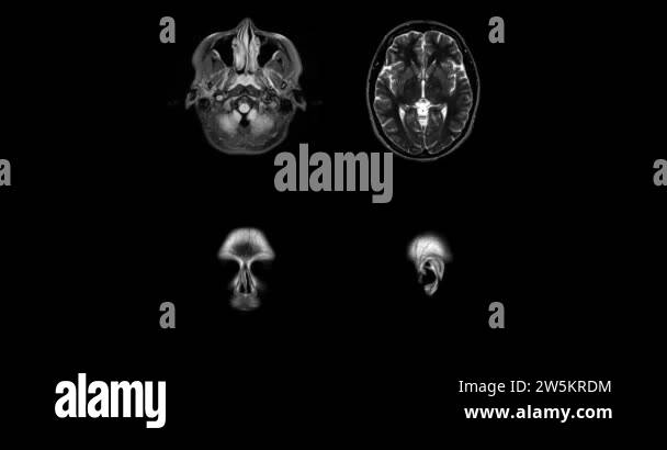 MRI of the brain in different projections. Horizontal, vertical ...