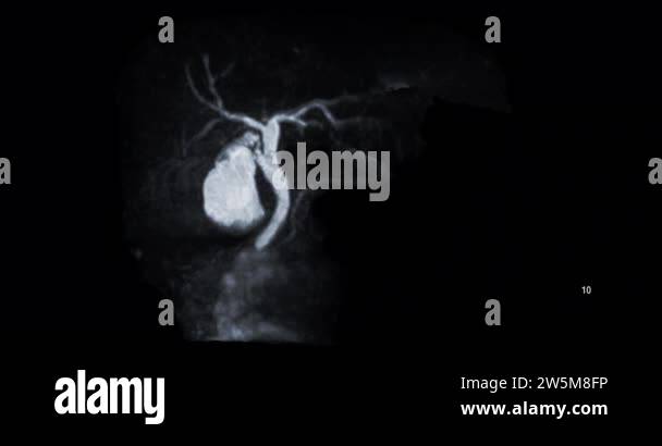 MRCP or Magnetic resonance cholangiopancreatography Coronal MIP showing ...