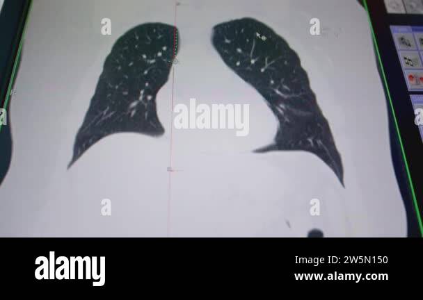 The result of a scan of the lungs on a computed tomograph. Lung model on a computer screen. CT ...