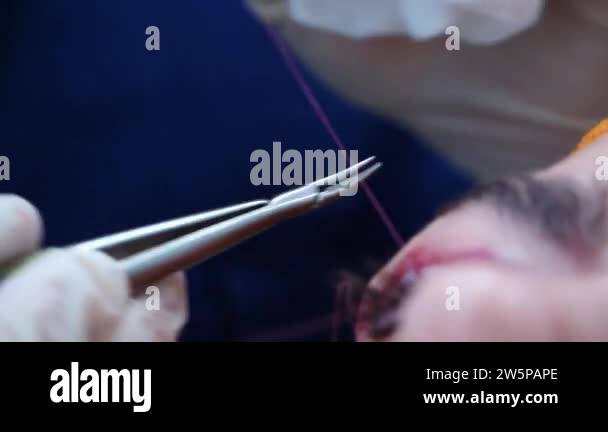 Close-up of a surgeon sutures the patients eyelids and cuts the thread ...